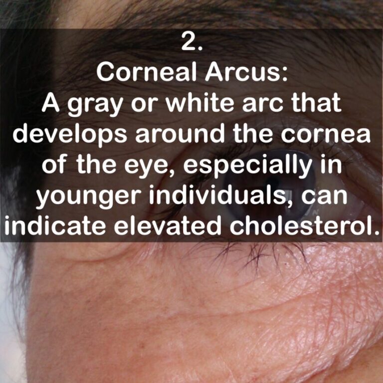 High Cholesterol Sign: (2/8) | MyHealthfulDiet.Com